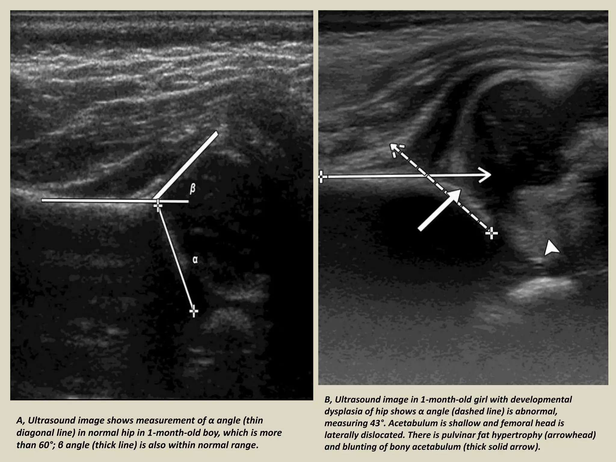 Presentation1, radiological imaging of developmental dysplasia of the ...