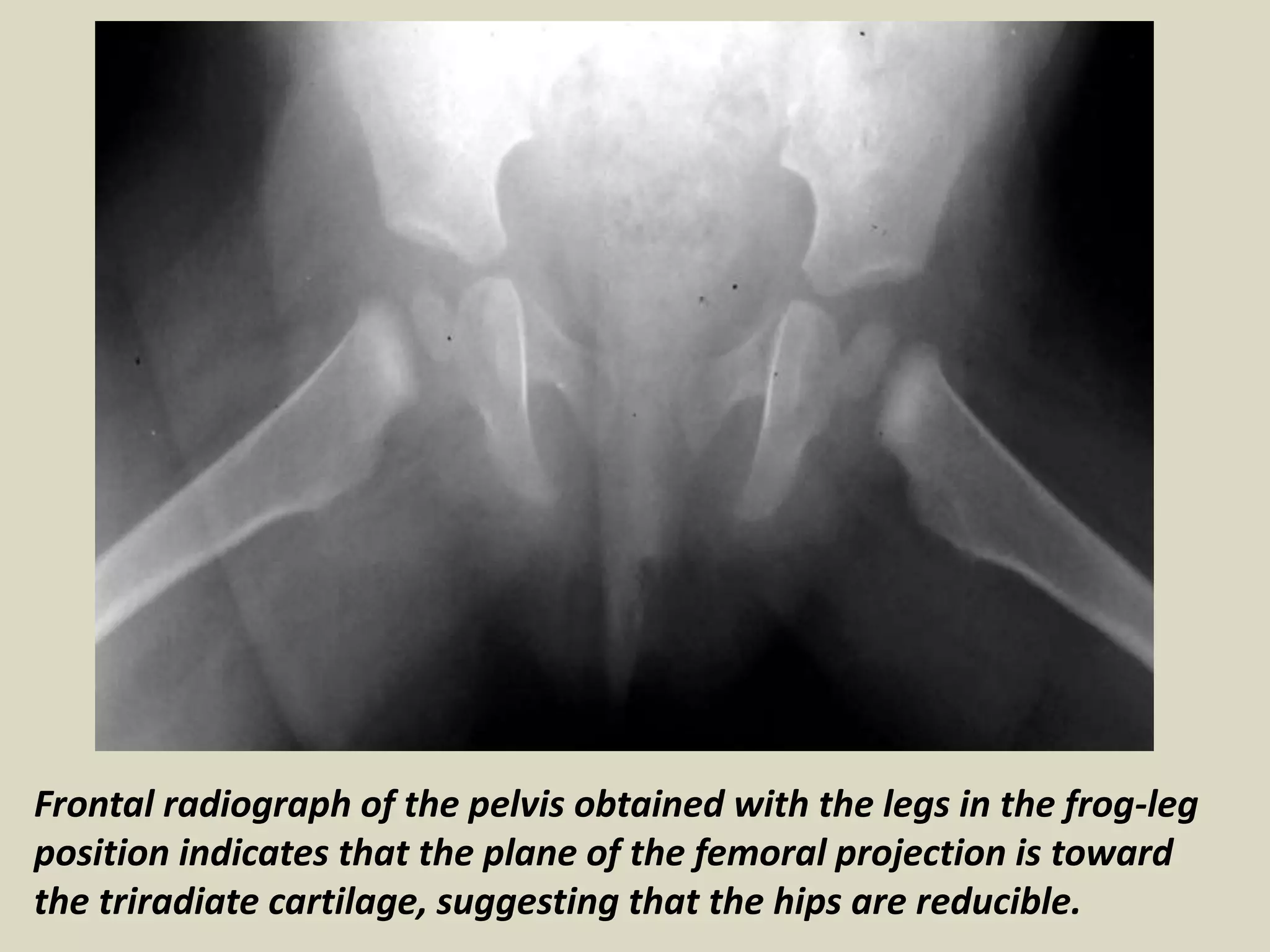 Presentation1, radiological imaging of developmental dysplasia of the ...