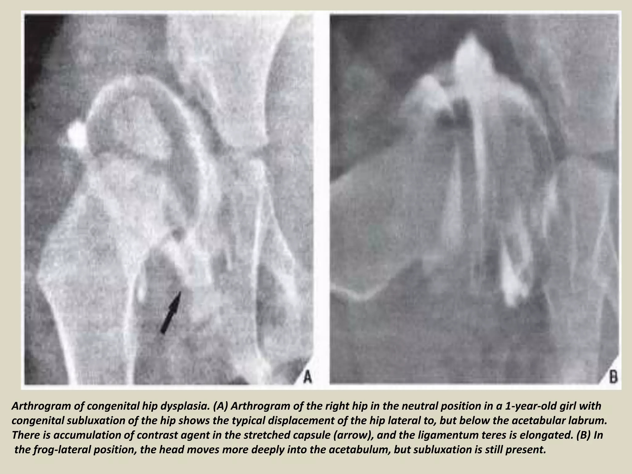 Presentation1, radiological imaging of developmental dysplasia of the ...