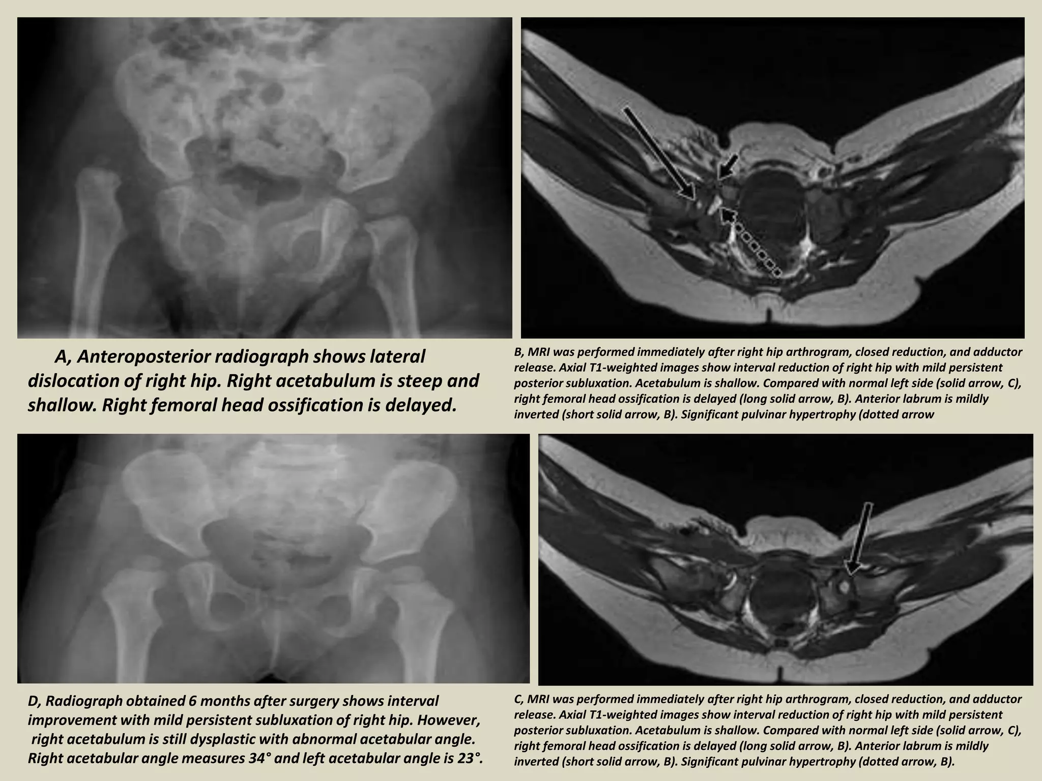 Presentation1, radiological imaging of developmental dysplasia of the ...