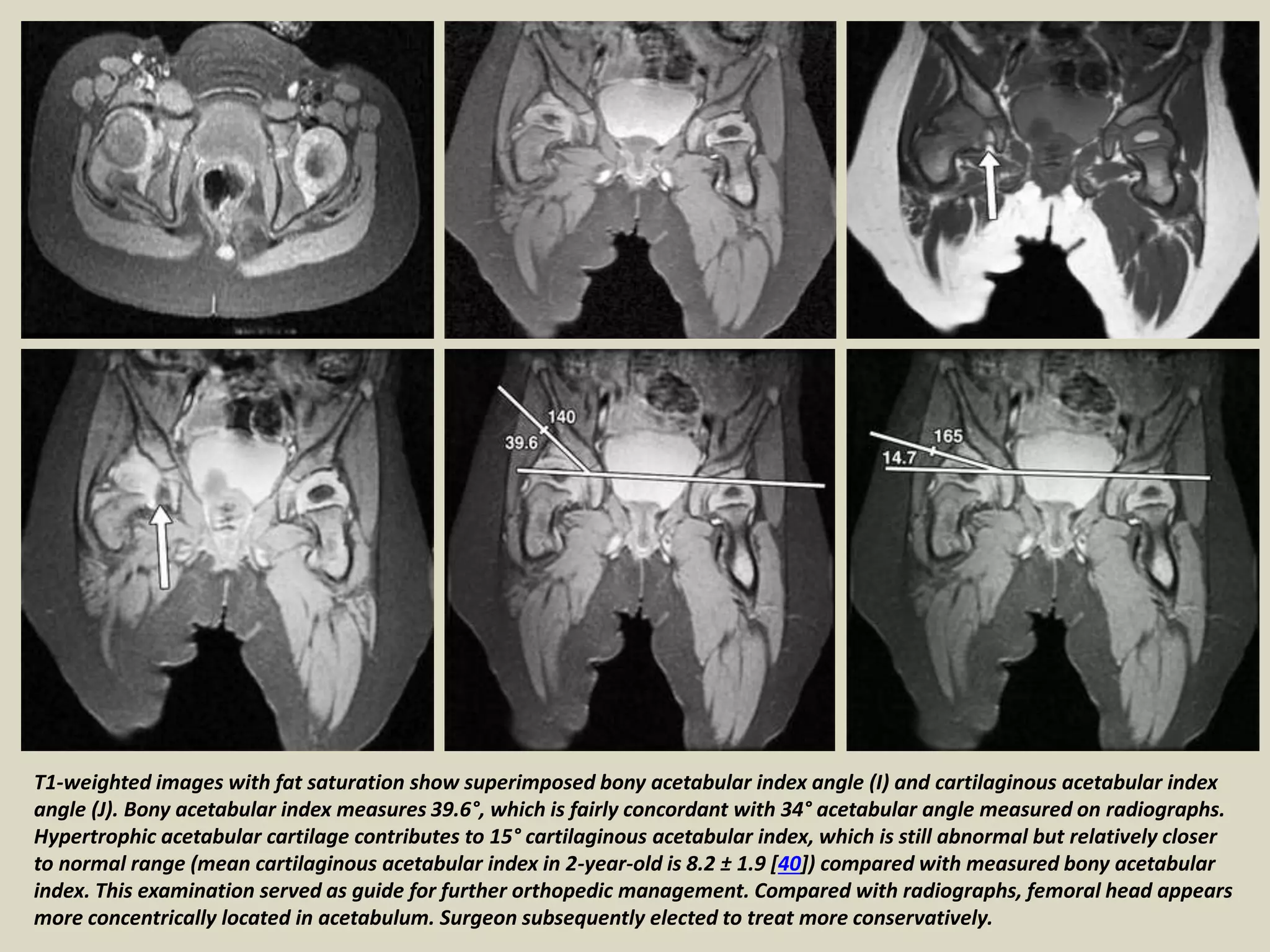Presentation1, radiological imaging of developmental dysplasia of the ...