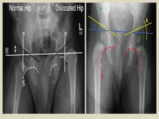 Developmental Dysplasia Of The Hip X Ray
