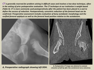 Congenital Hip Dysplasia Radiology