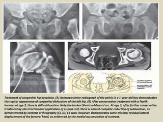 Congenital Hip Dysplasia Radiology
