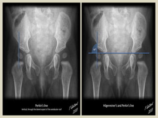 Congenital Hip Dysplasia Xray