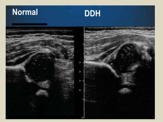Presentation1, radiological imaging of developmental dysplasia of the…