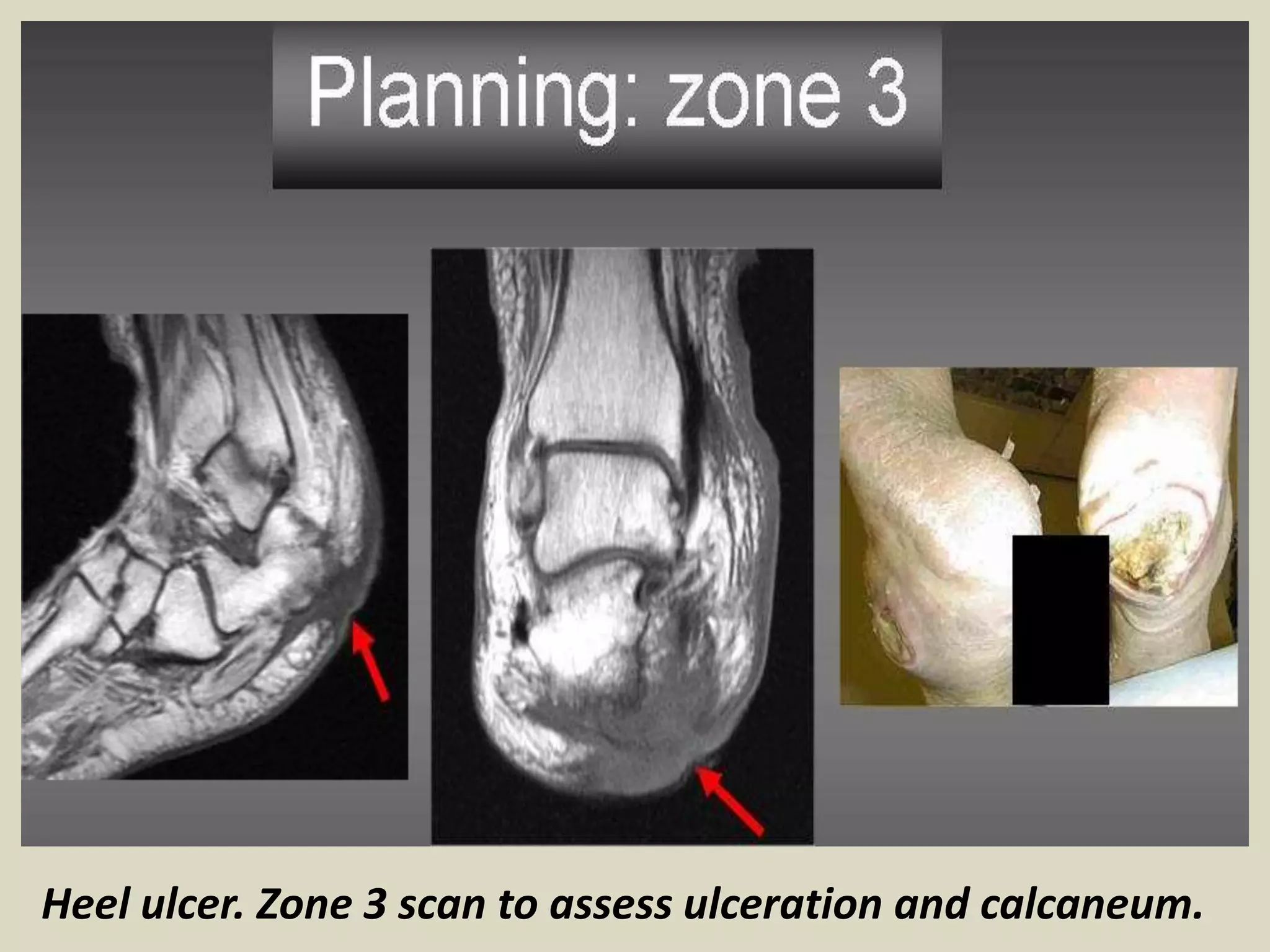 Presentation1, radiological imaging of diabetic foor and charcot joint ...