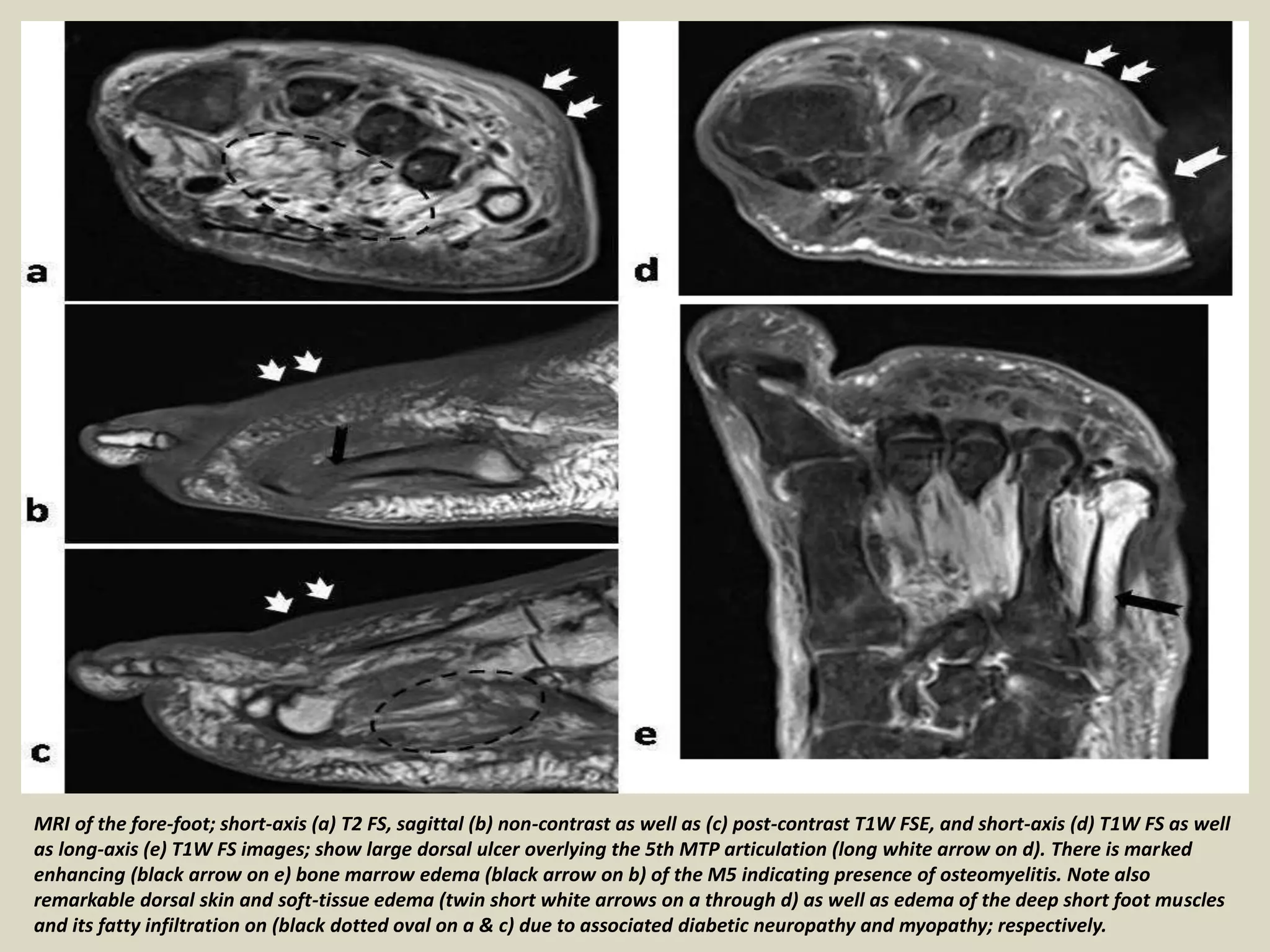 Presentation1, radiological imaging of diabetic foor and charcot joint ...