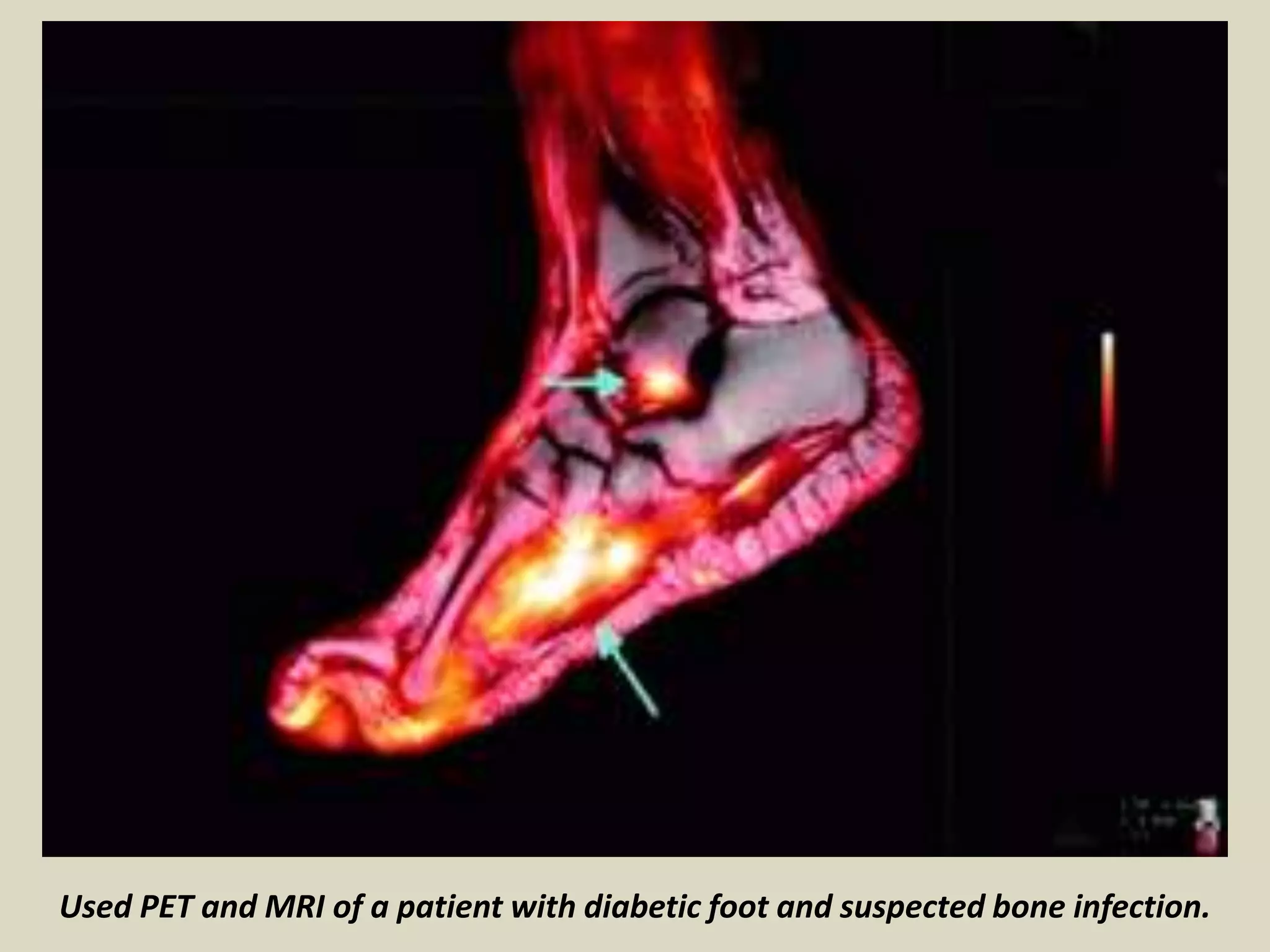 Presentation1, radiological imaging of diabetic foor and charcot joint ...