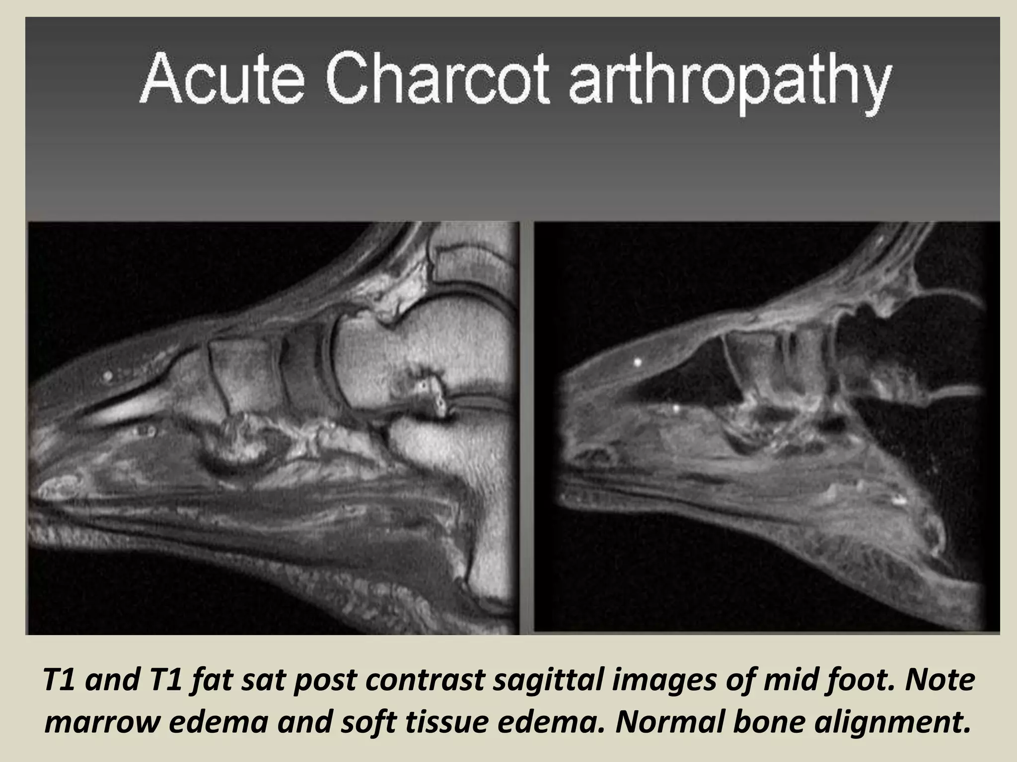 Presentation1, radiological imaging of diabetic foor and charcot joint ...