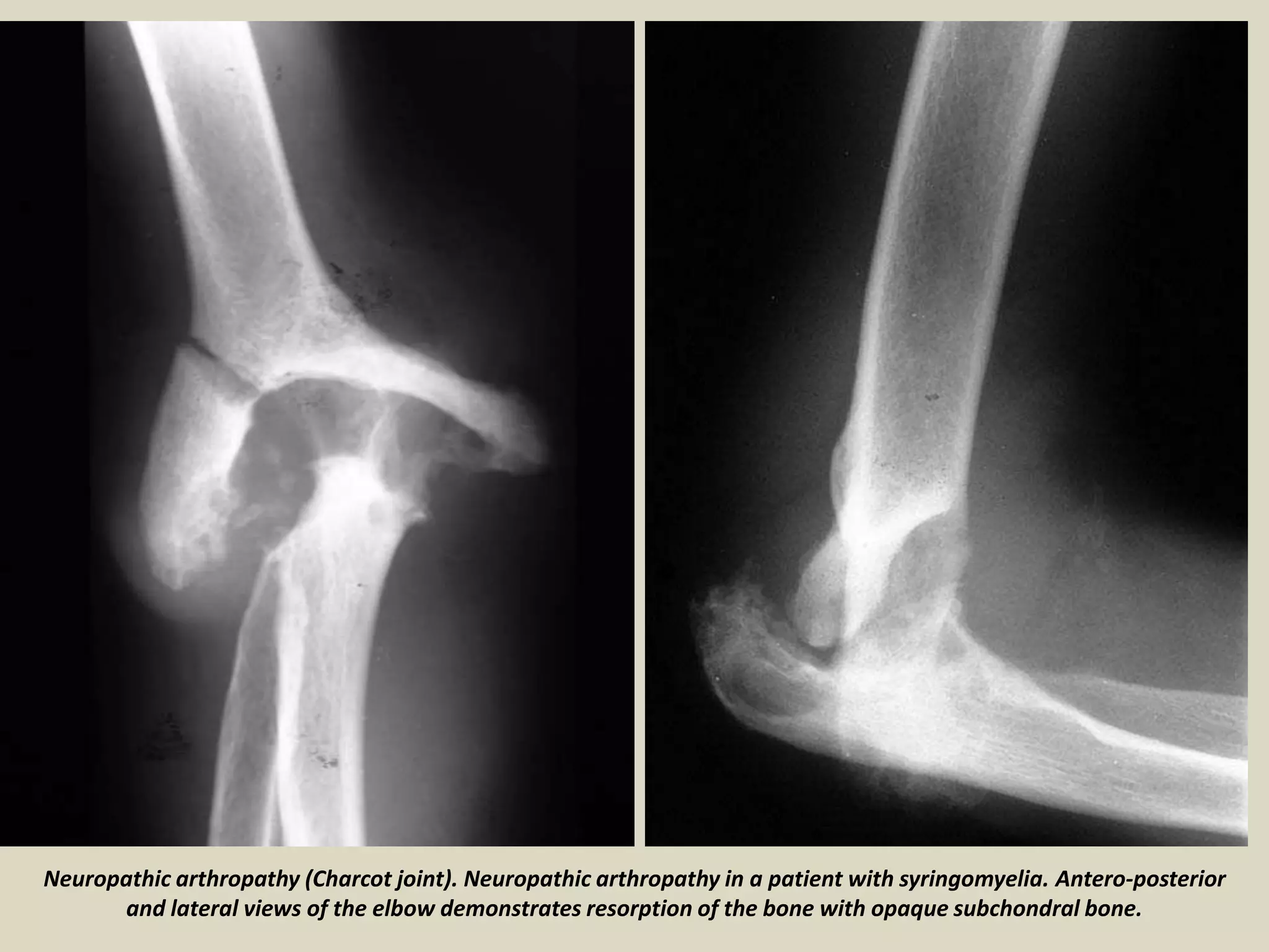 Presentation1, radiological imaging of diabetic foor and charcot joint ...