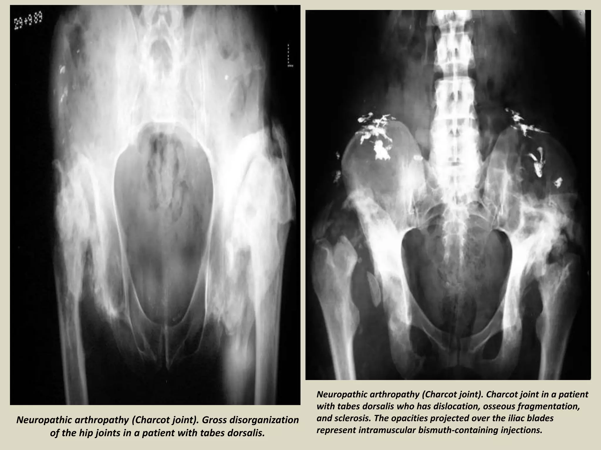 Presentation1, radiological imaging of diabetic foor and charcot joint ...
