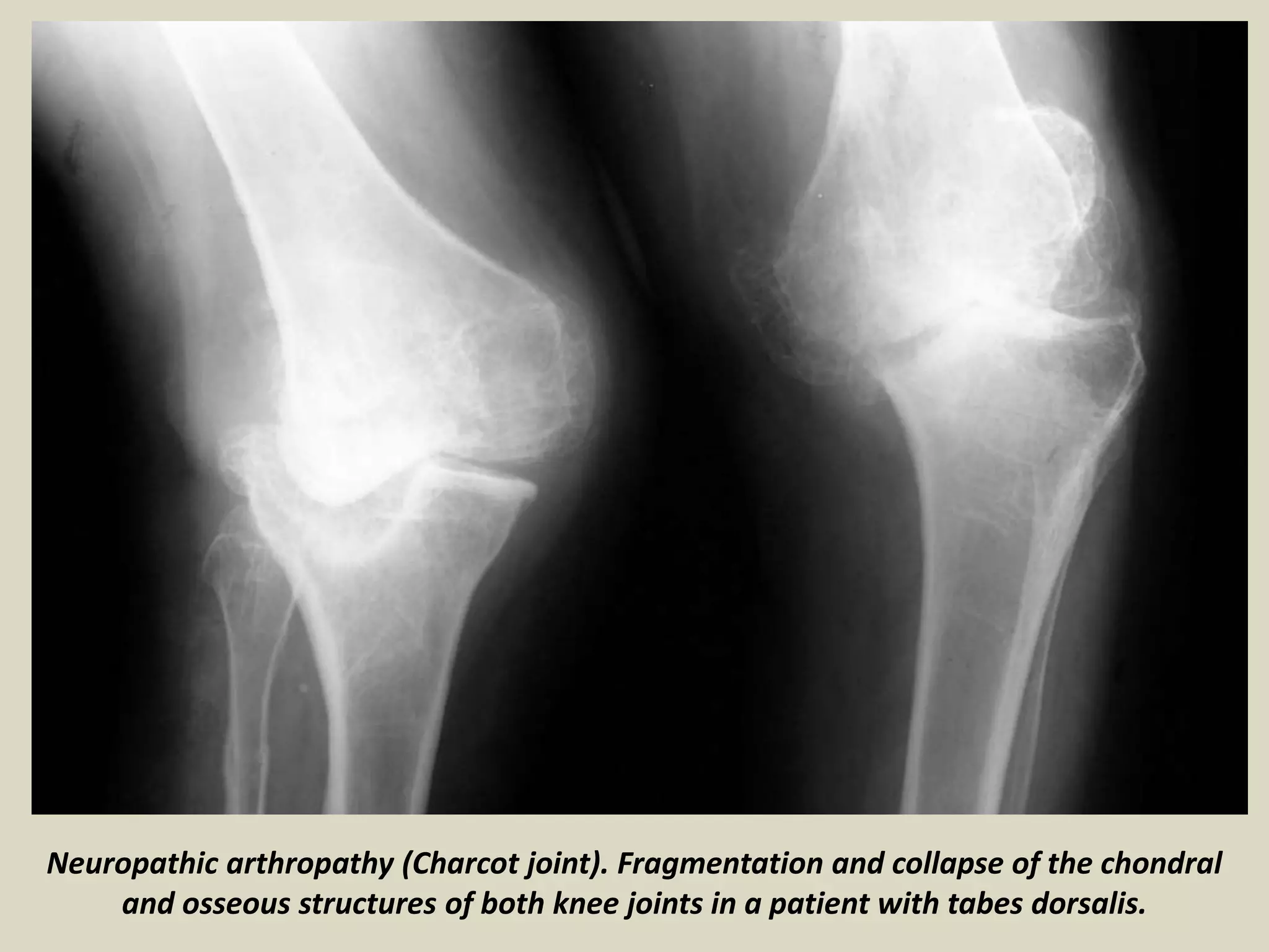 Presentation1, radiological imaging of diabetic foor and charcot joint ...