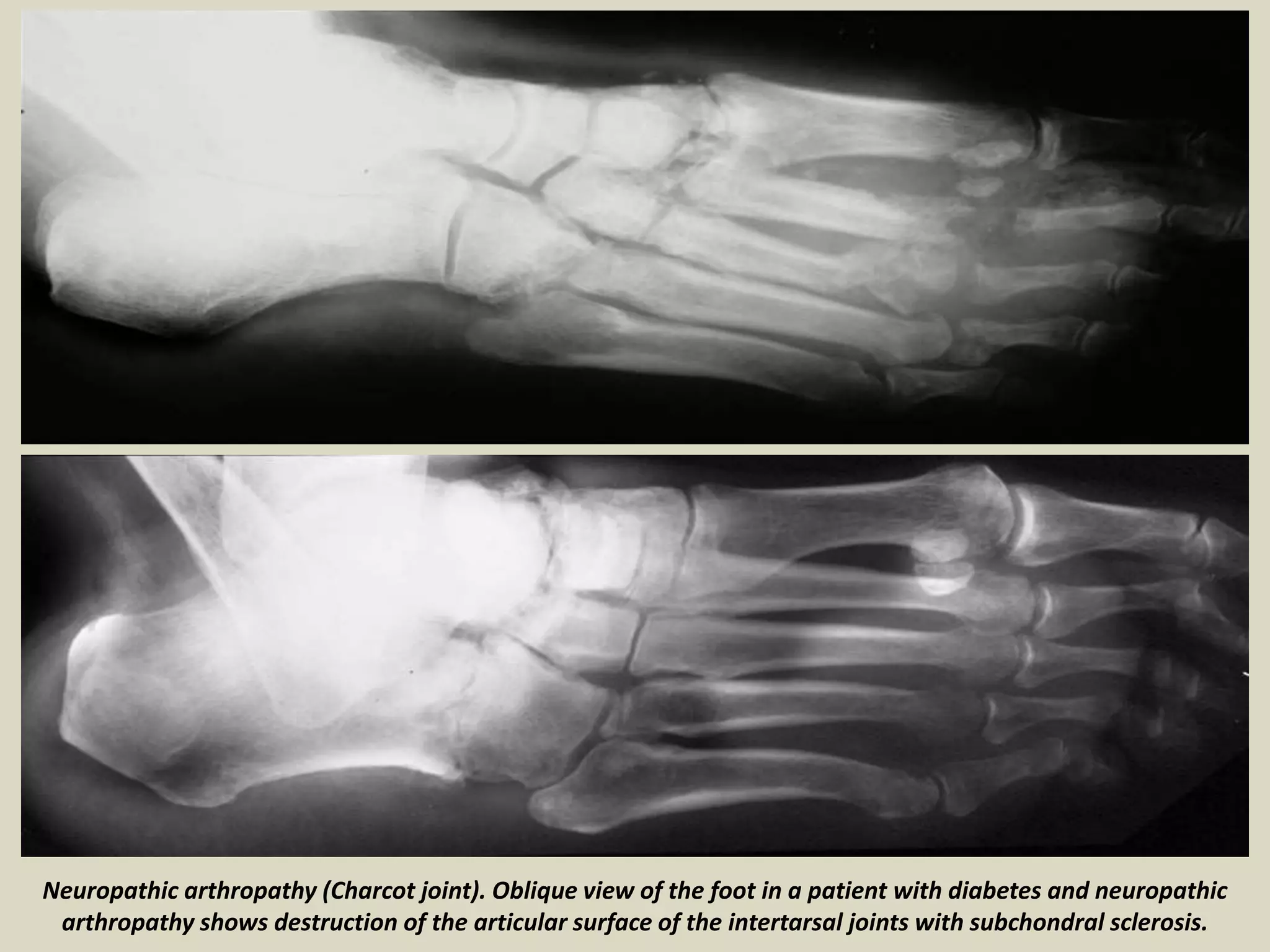 Presentation1, radiological imaging of diabetic foor and charcot joint ...