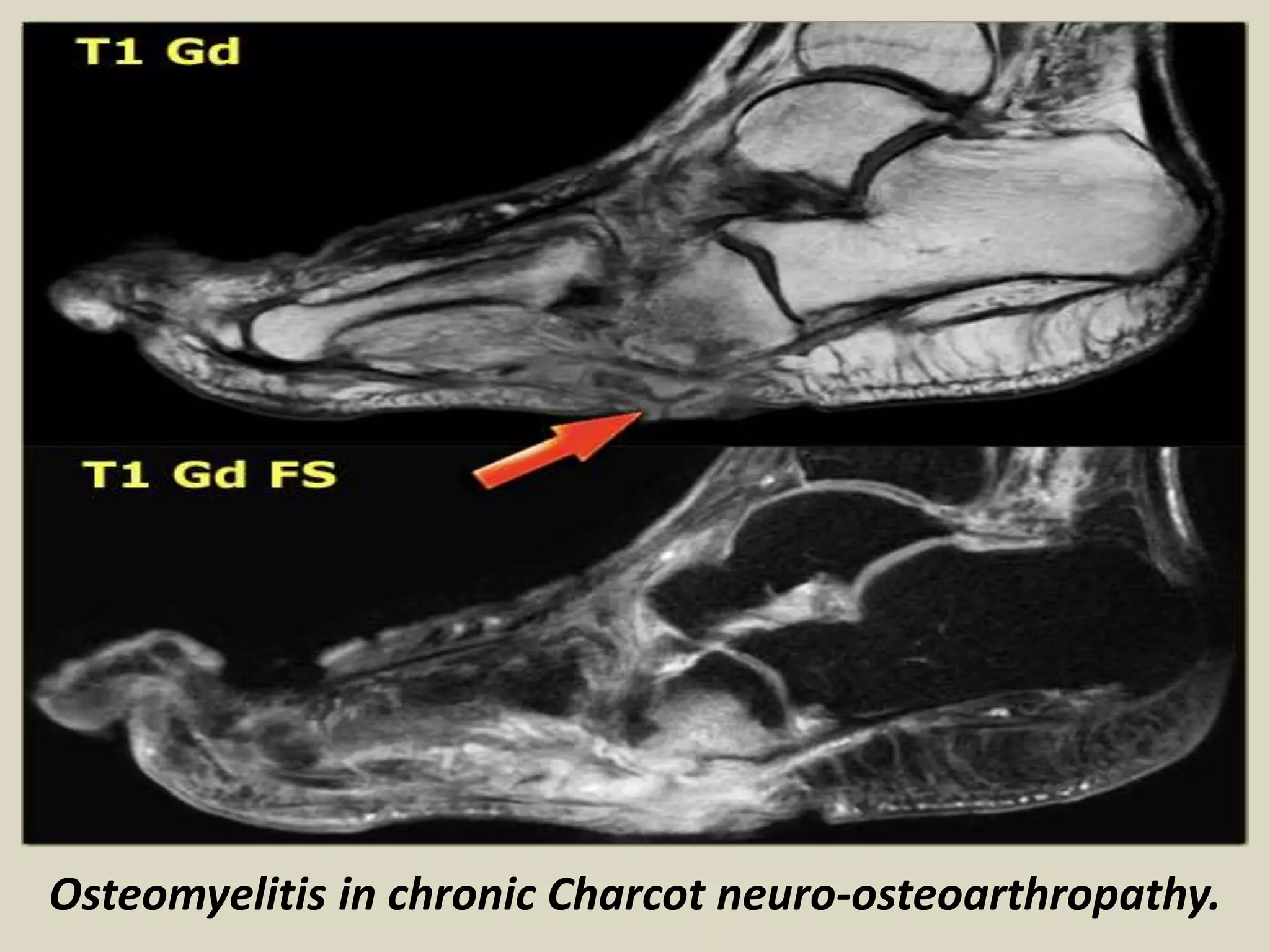 Presentation1, radiological imaging of diabetic foor and charcot joint ...