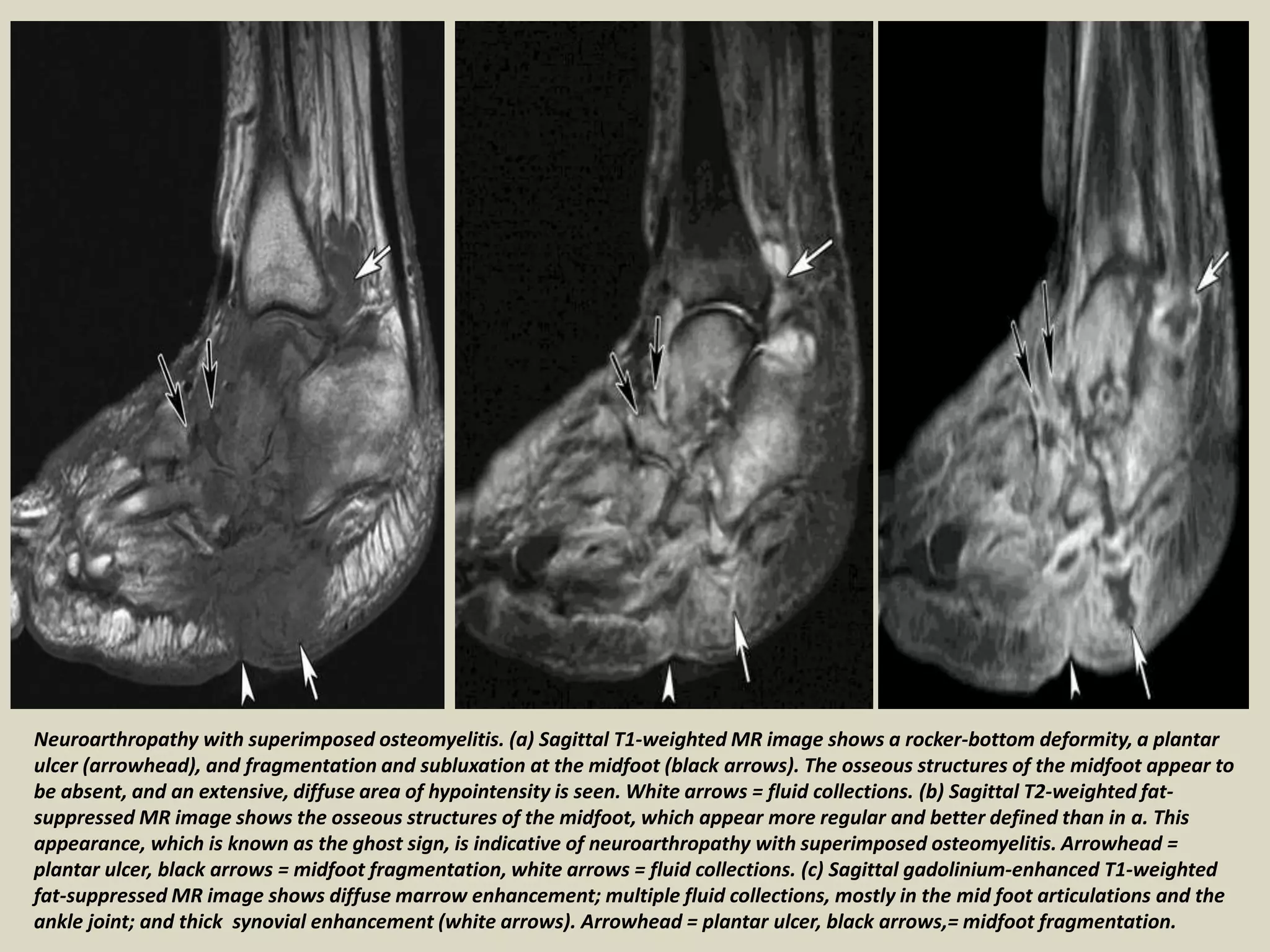 Presentation1, radiological imaging of diabetic foor and charcot joint ...
