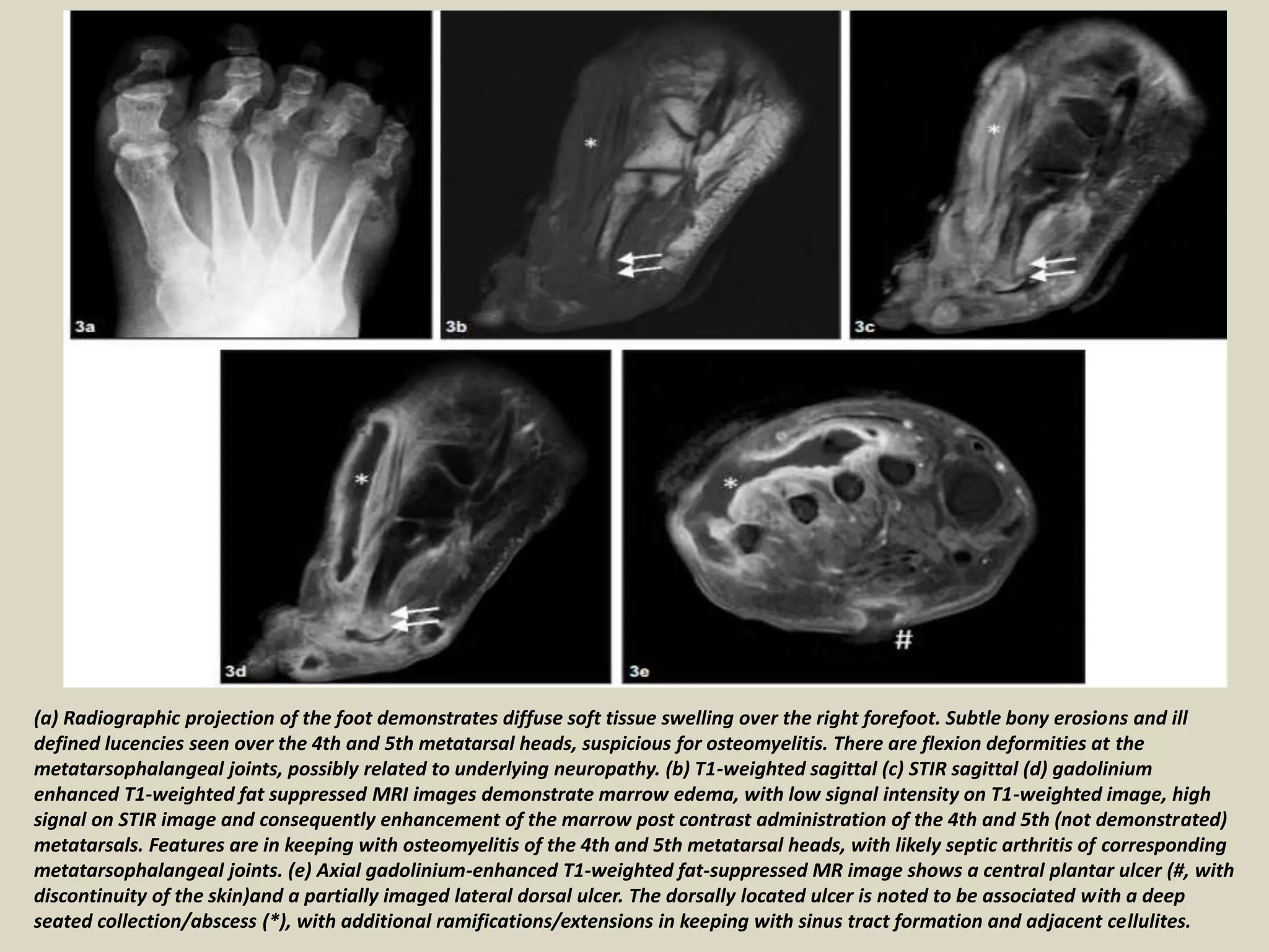 Presentation1, radiological imaging of diabetic foor and charcot joint ...