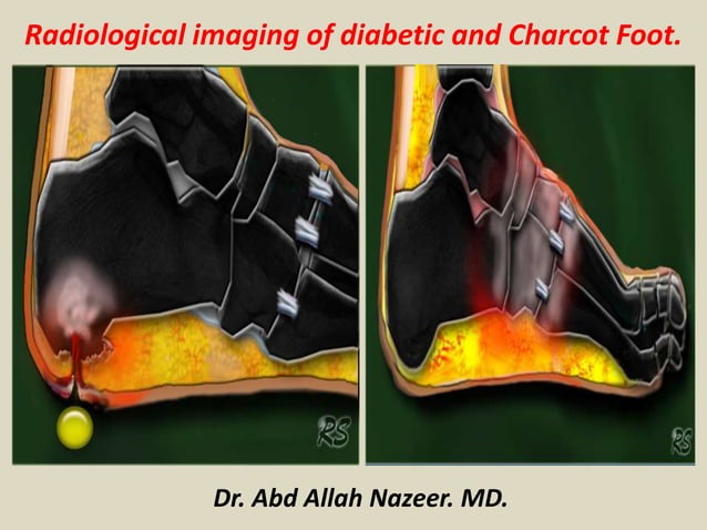 Presentation1, radiological imaging of diabetic foor and charcot joint ...