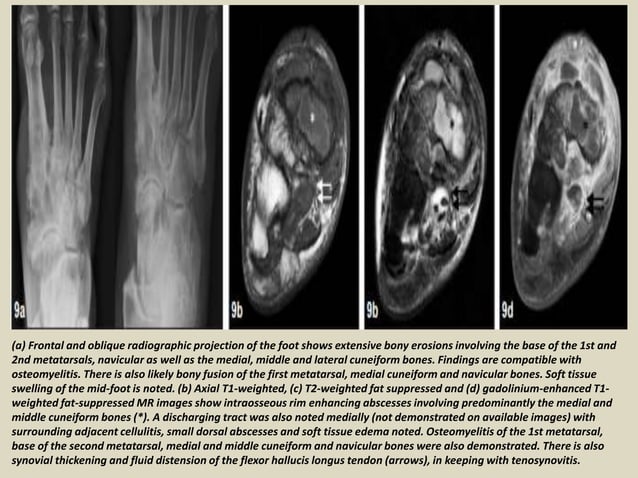 Presentation1, radiological imaging of diabetic foor and charcot joint ...