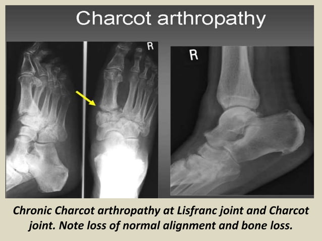 Presentation1, radiological imaging of diabetic foor and charcot joint ...