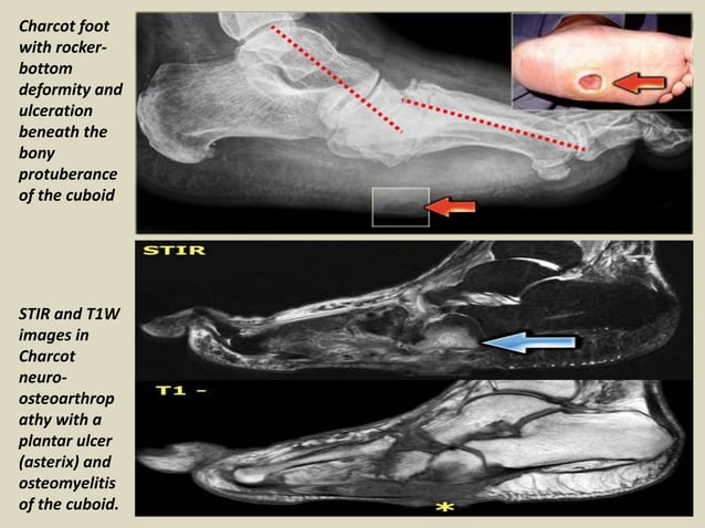 Presentation1, radiological imaging of diabetic foor and charcot joint ...