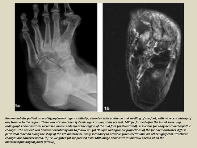 Presentation1, radiological imaging of diabetic foor and charcot joint ...