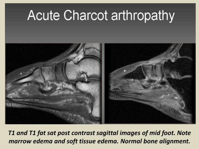 Presentation1, radiological imaging of diabetic foor and charcot joint.