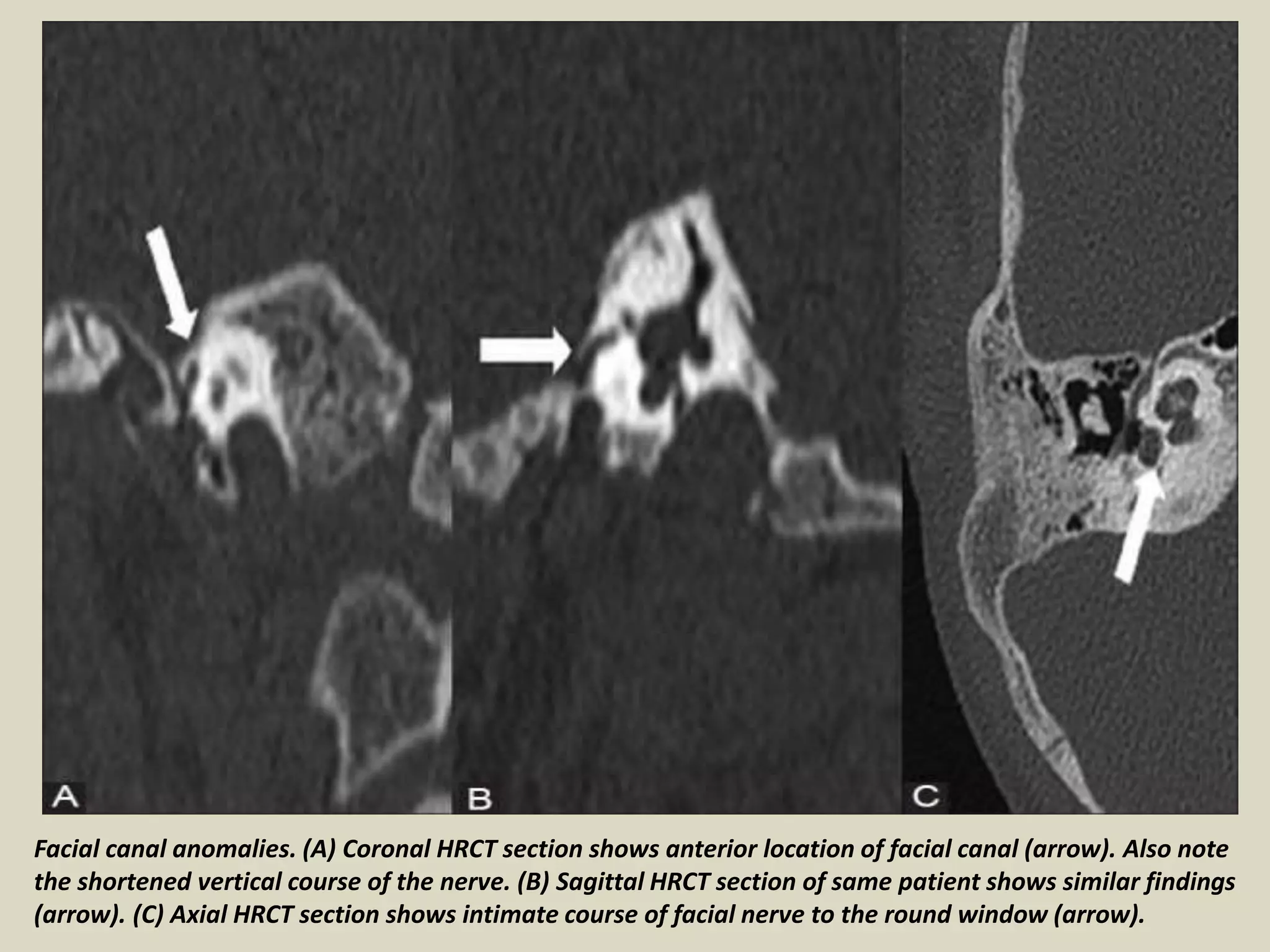 Presentation1, radiological imaging of ear microcia. | PPT