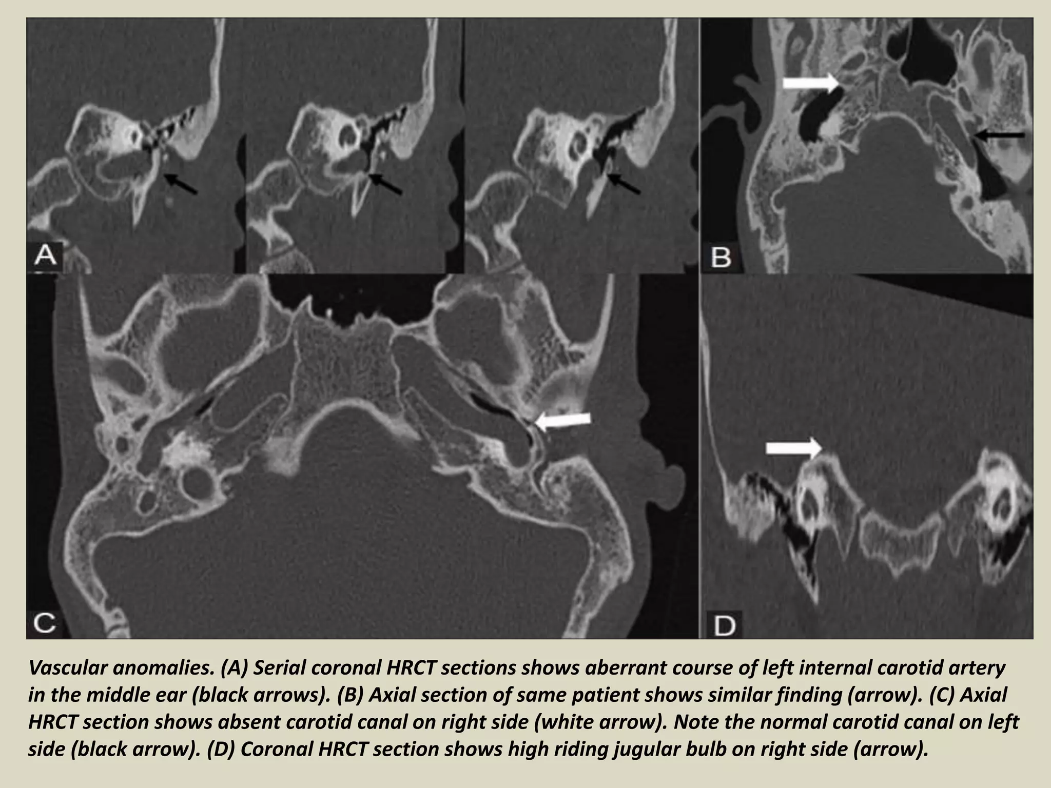 Presentation1, radiological imaging of ear microcia. | PPT