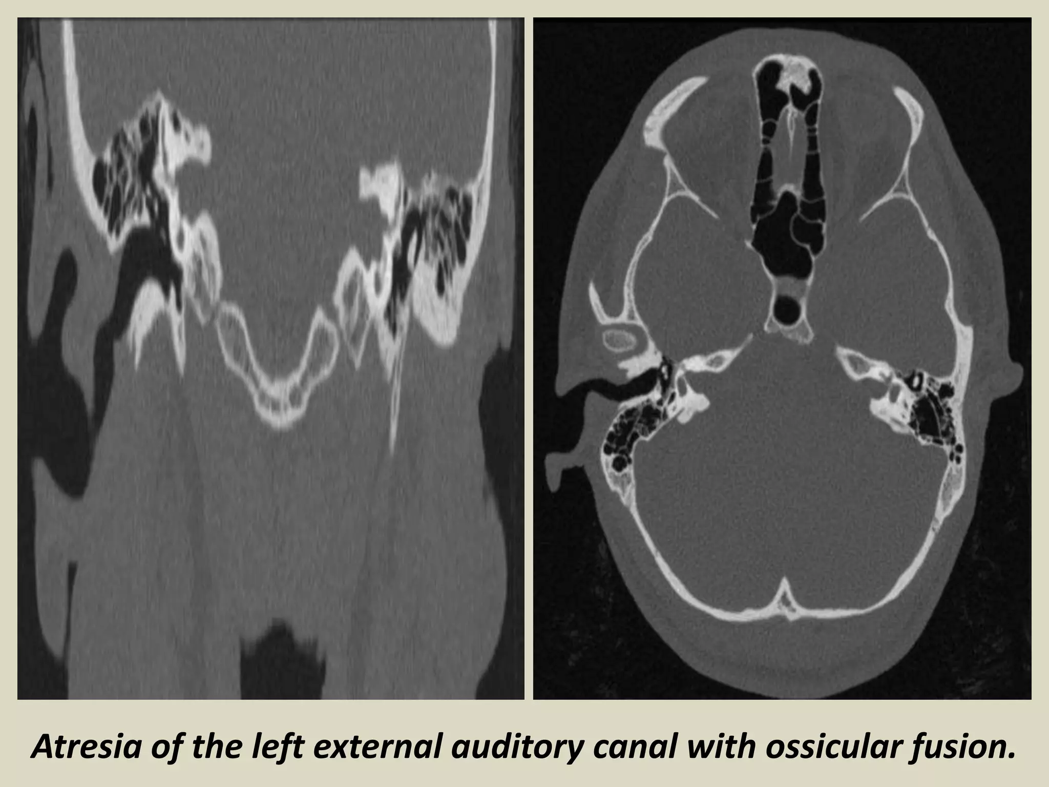 Presentation1, radiological imaging of ear microcia. | PPT