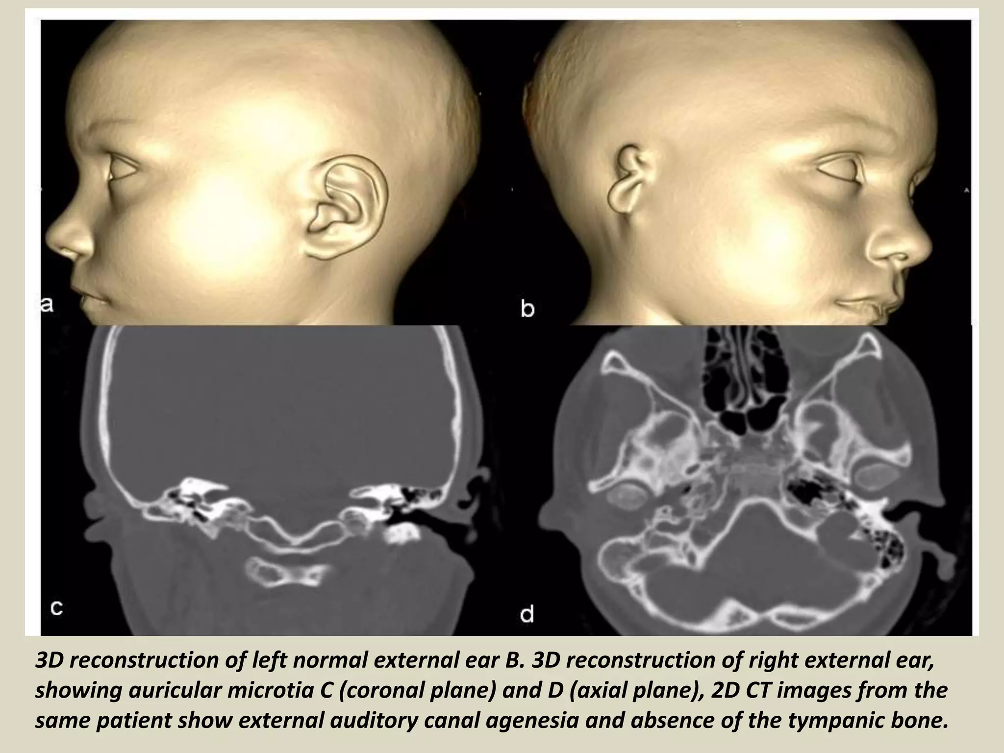 Presentation1, radiological imaging of ear microcia. | PPT