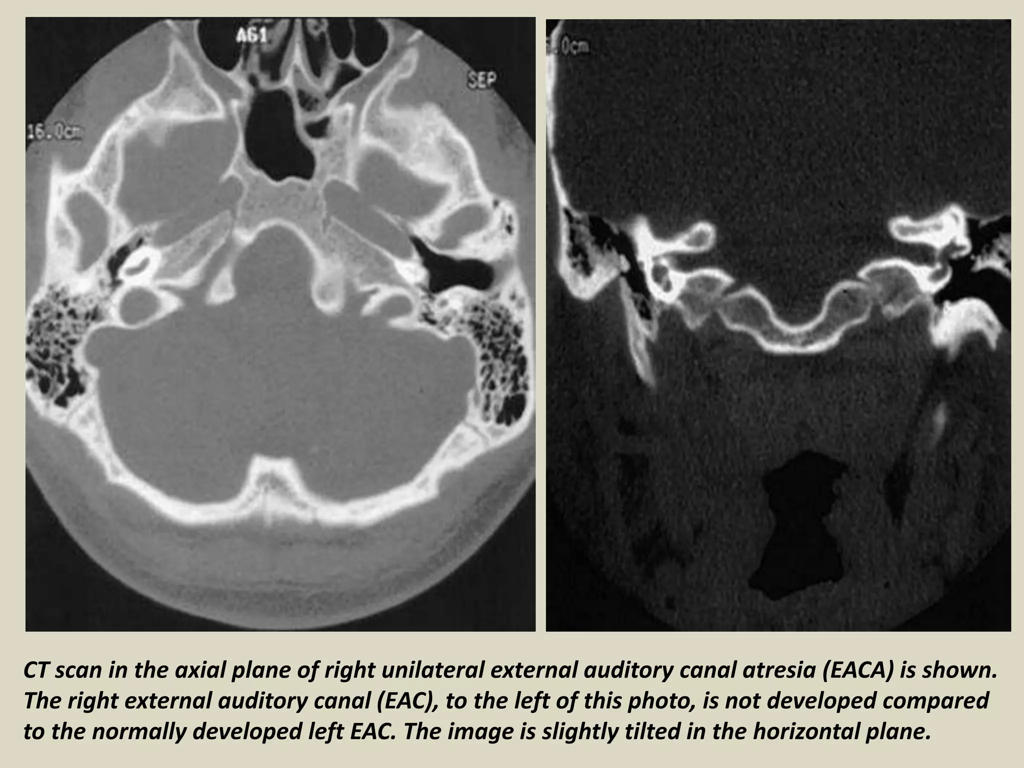 Presentation1, radiological imaging of ear microcia. | PPT