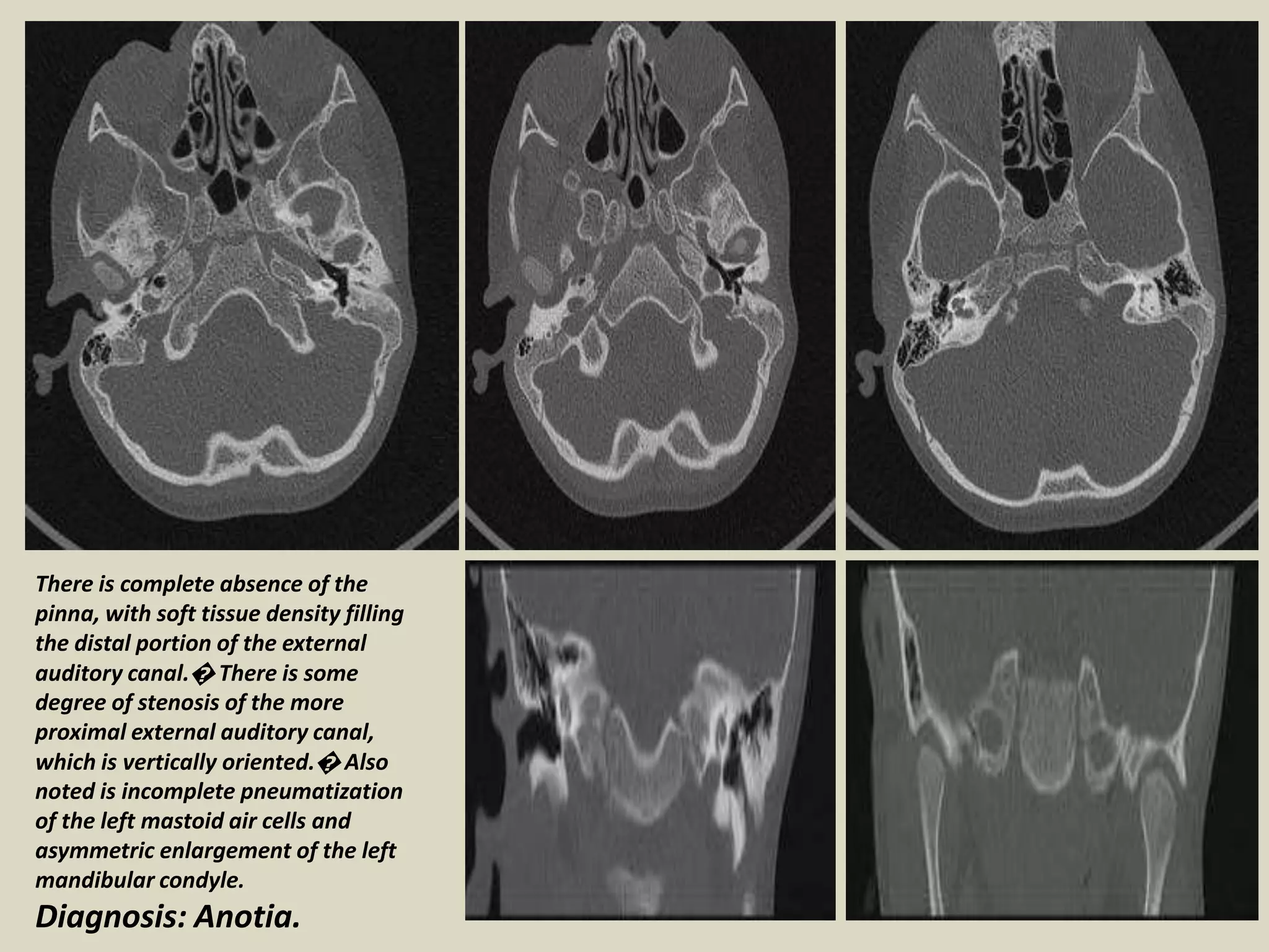 Presentation1, radiological imaging of ear microcia. | PPT