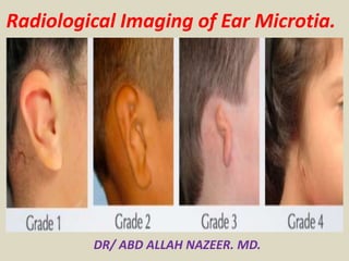 Presentation1, radiological imaging of ear microcia. | PPT