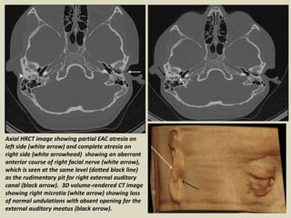 Presentation1, radiological imaging of ear microcia. | PPTX