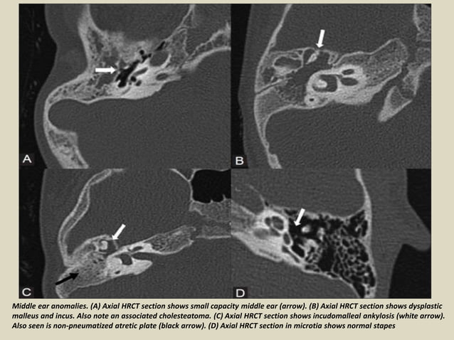 Presentation1, radiological imaging of ear microcia. | PPT