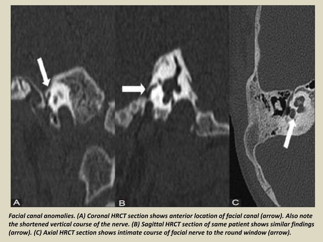 Presentation1, radiological imaging of ear microcia. | PPT