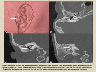 Presentation1, radiological imaging of ear microcia. | PPTX