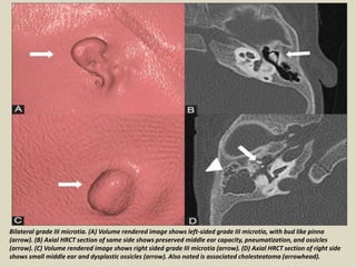Presentation1, radiological imaging of ear microcia. | PPTX