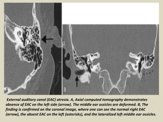 Presentation1, radiological imaging of ear microcia. | PPTX