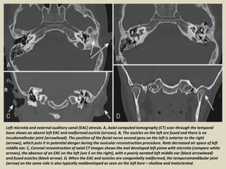 Presentation1, radiological imaging of ear microcia. | PPTX