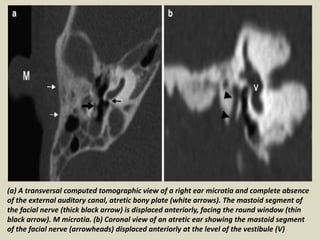 Presentation1, radiological imaging of ear microcia. | PPTX