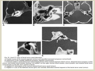 Presentation1, radiological imaging of ear microcia. | PPTX