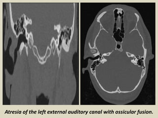 Presentation1, radiological imaging of ear microcia. | PPTX