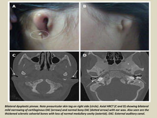 Presentation1, radiological imaging of ear microcia. | PPTX