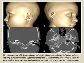 Presentation1, radiological imaging of ear microcia. | PPTX