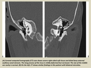 Presentation1, radiological imaging of ear microcia. | PPTX