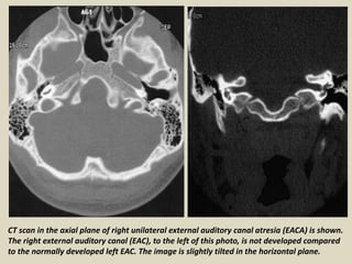 Presentation1, radiological imaging of ear microcia. | PPTX