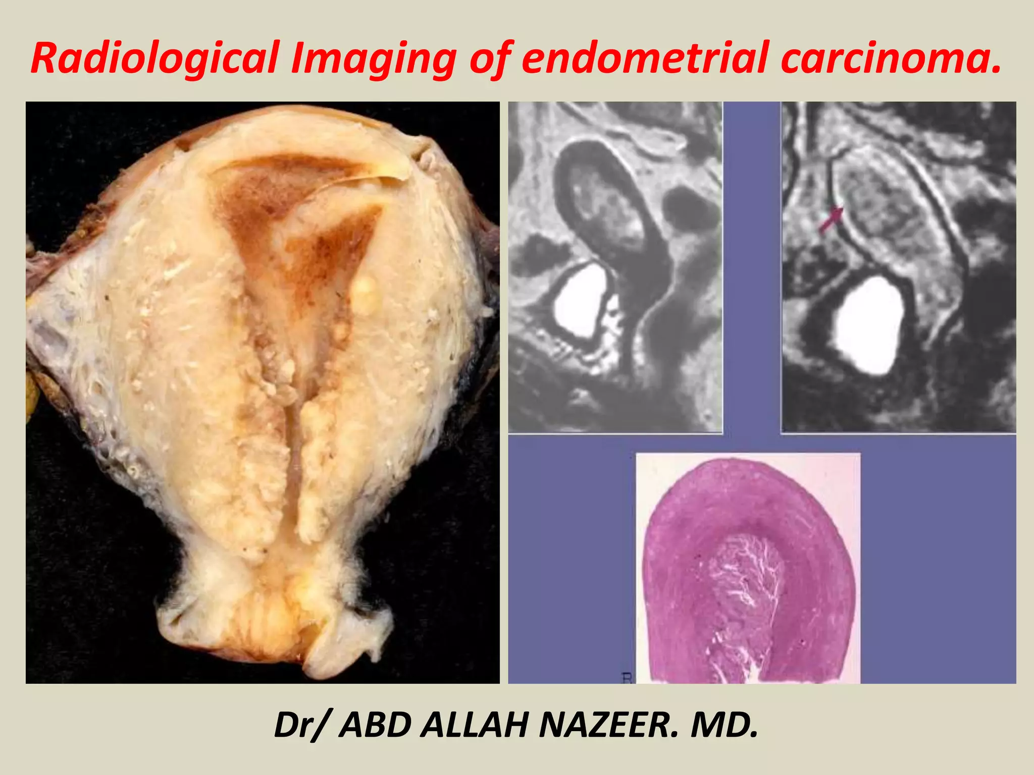 Presentation1, radiological imaging of endometrial carcinoma. | PPTX