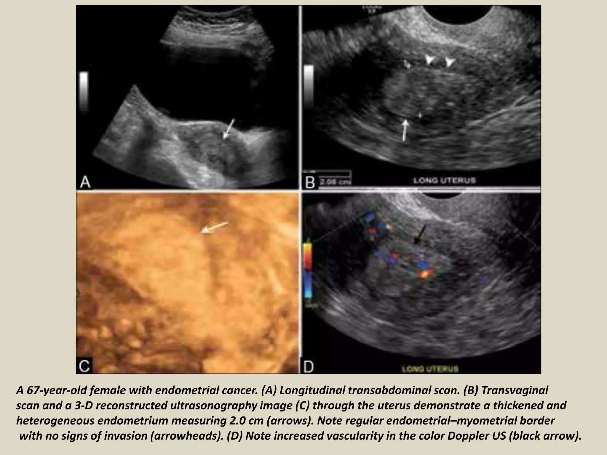 Presentation1, radiological imaging of endometrial carcinoma. | PPTX